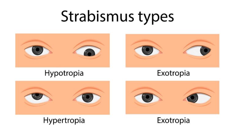 Squint in Children & Babies: Causes, Types, Treatment & Surgery Age